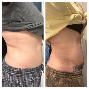 Infraslim® HeatSculpt+